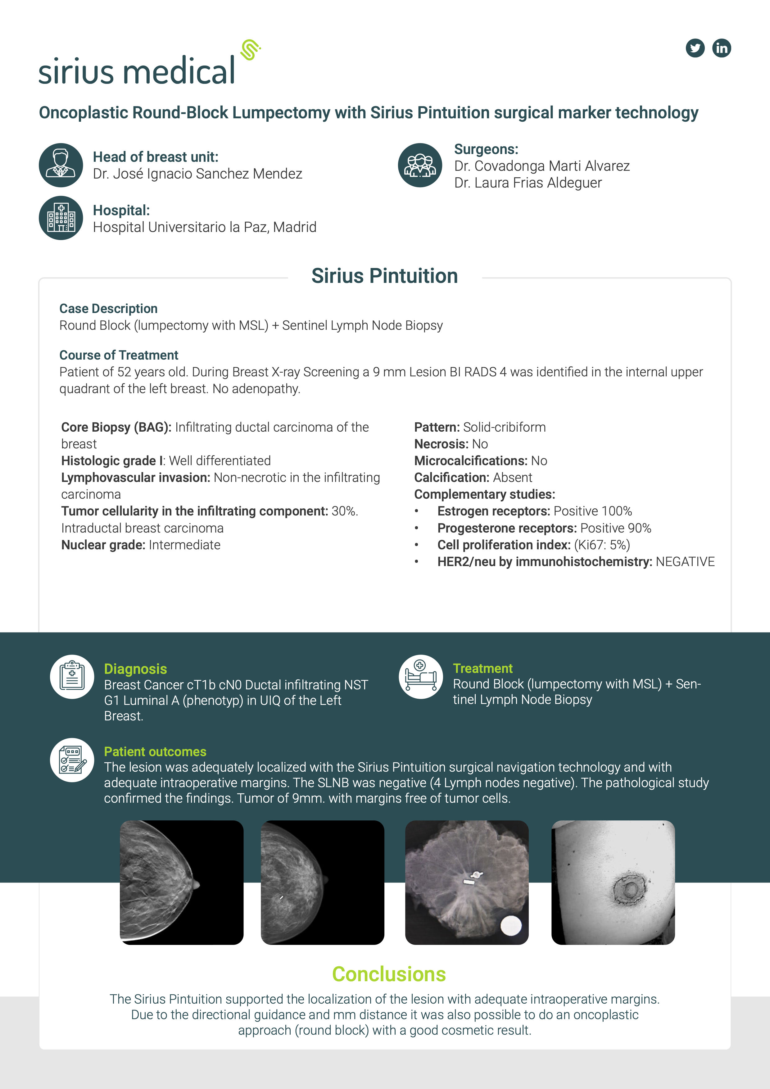 Oncoplastic Round-Block Lumpectomy with Sirius Pintuition surgical ...